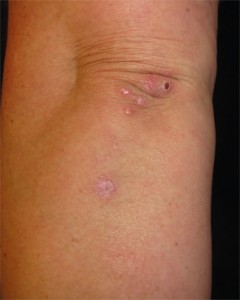 Case Study in Dermatology: Tender Papules on Elbows, Hands in RA - The ...
