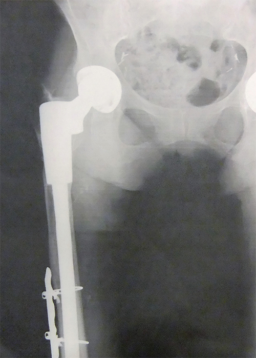 Rheumatoid Arthritis Patient Shares Lessons Learned from Breaking Leg ...