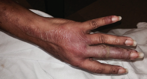 Lupus Rash On Hands