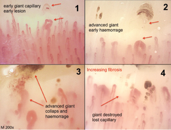 Rheumatologists Find Nailfold Capillaroscopy an Increasingly Useful ...