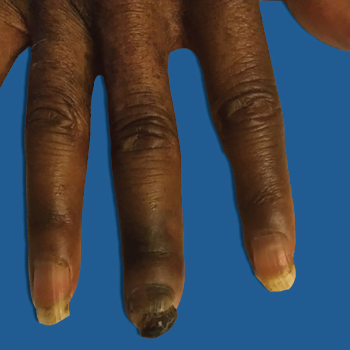 Case Report: Cardiac Complications in Scleroderma - The Rheumatologist