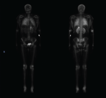 Case Report: Refractory Calciphylaxis in Lupus - Page 3 of 6 - The ...