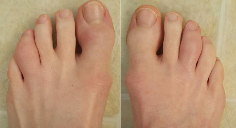 Case Report: A Psoriatic Arthritis Patient with Dactylitis & Enthesitis ...