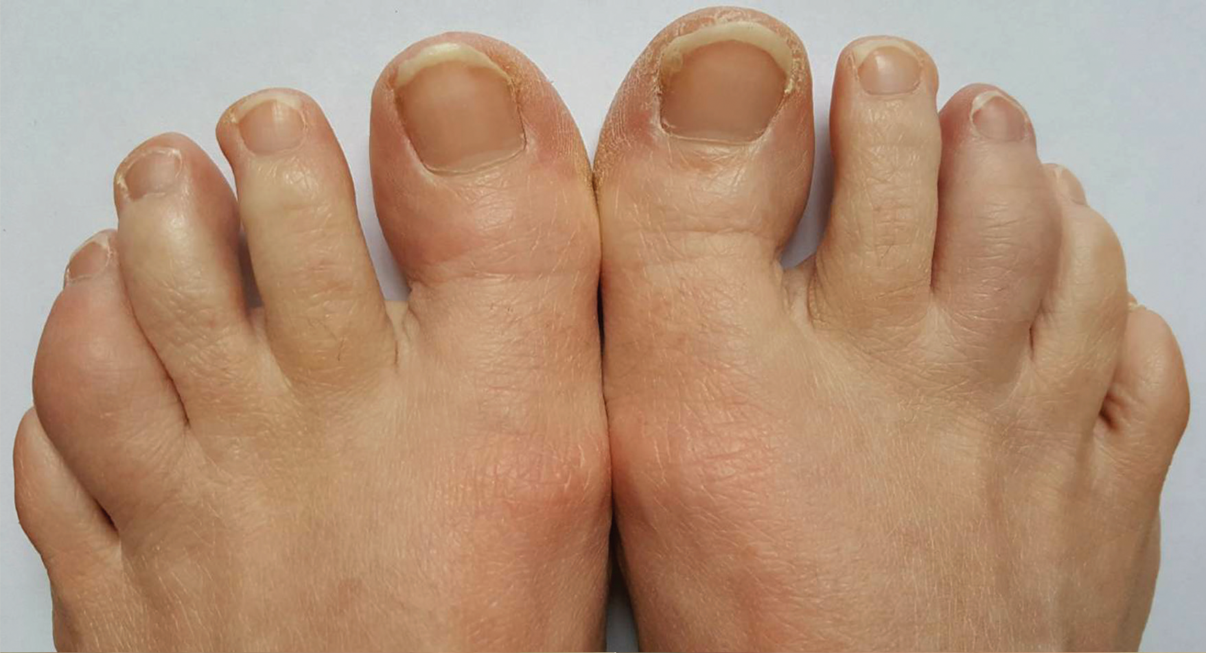 Case Report: A Psoriatic Arthritis Patient with Dactylitis & Enthesitis ...