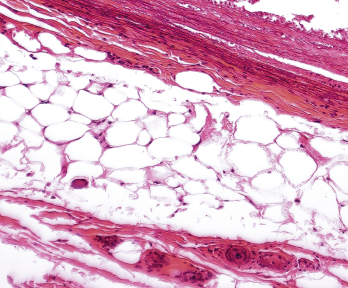 Researchers Probe the Role of Fat Cells in Inflammation - The ...