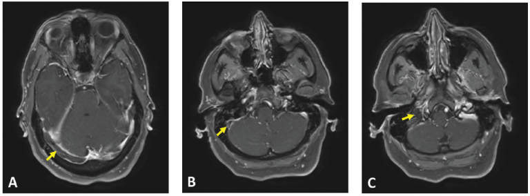 Case Report: A Behçet’s Patient Develops Cerebral Venous Sinus Thrombi ...