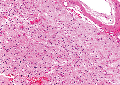 Case Report: Lymphocytic Vasculitis of the Central Nervous System ...