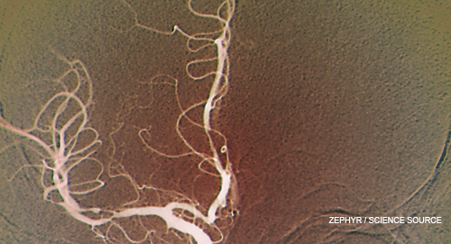 Case Report: Lymphocytic Vasculitis of the Central Nervous System - The ...
