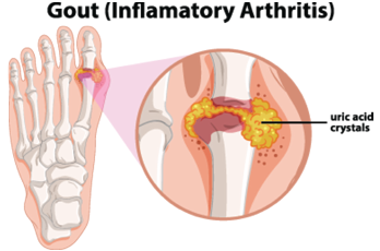 The ACR's & EULAR's Gout Guidelines Include Treatment Approaches - The Rheumatologist