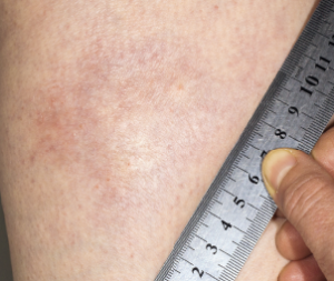 Study Probes New Gene Therapy for Severe, Localized Scleroderma ...