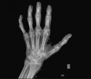 Case Report: Not All Crystals Are Gout - The Rheumatologist