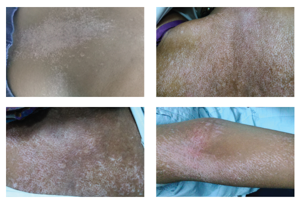 Case Report: Can Salt-&-Pepper Skin Mean Systemic Sclerosis? - The ...