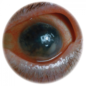 Ankylosing Spondylitis & Uveitis: An Ophthalmologist's Perspective ...