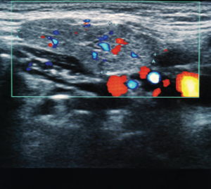 Ultrasound in Rheumatology—Past, Present & Future - The Rheumatologist