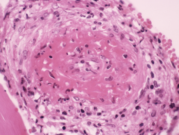 Study Looks at Cryoglobulin Detection & Immunological Characteristics ...