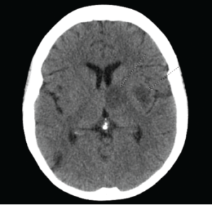 Case Study: Cerebral Toxoplasmosis in a Newly Diagnosed Lupus Patient ...