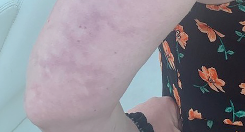 Case Report: Diagnosing Sneddon Syndrome - The Rheumatologist