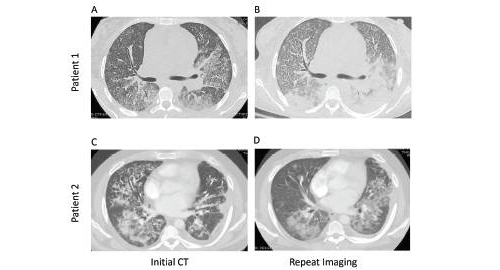 2 Cases of SLE-Associated Diffuse Alveolar Hemorrhage - The Rheumatologist