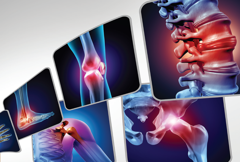 Axial Disease in Psoriatic Arthritis - The Rheumatologist