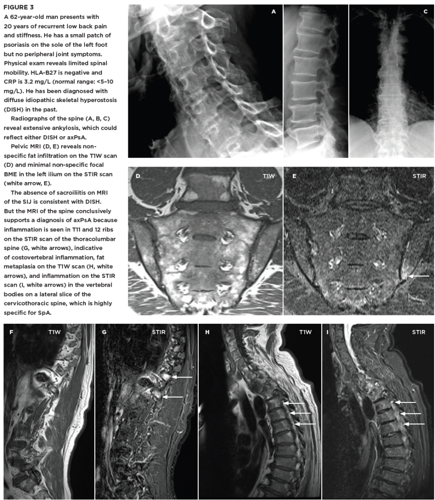 Imaging of Axial Psoriatic Arthritis - The Rheumatologist