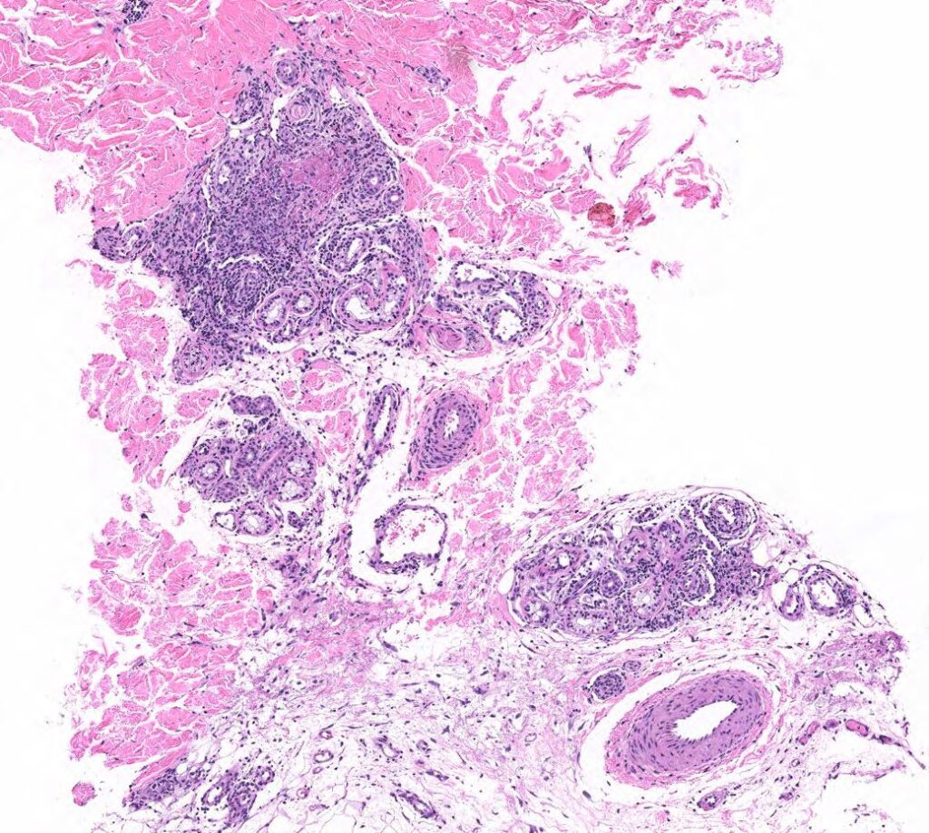 A Case of Nodular Rash & Painful Joints - Page 3 of 5 - The Rheumatologist