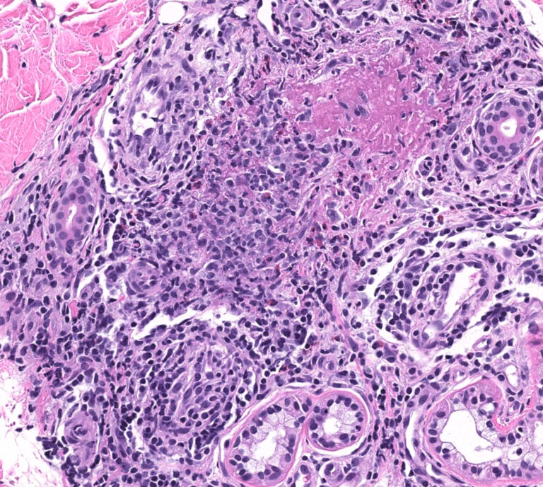 A Case of Nodular Rash & Painful Joints - Page 3 of 5 - The Rheumatologist