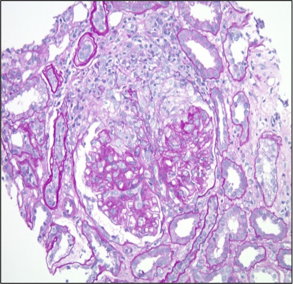 Case Report: Migratory Polyarthritis as the Presenting Symptom of GPA ...