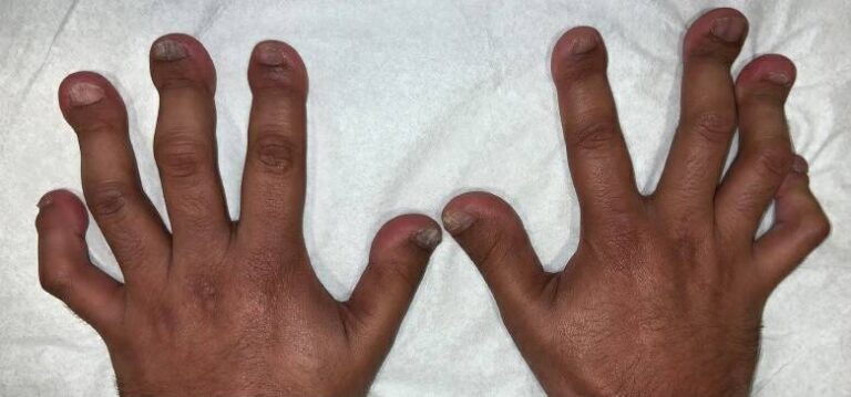 Case Report: Hajdu-Cheney Syndrome - The Rheumatologist