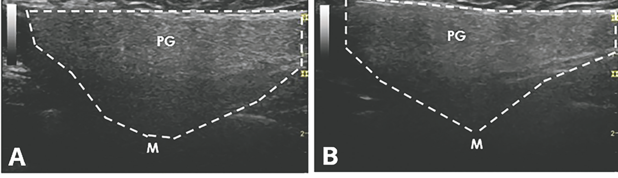 Image Case Report: Glandular Swelling - The Rheumatologist