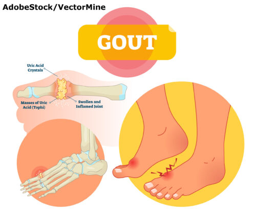 Gout and Heart Health - The Rheumatologist