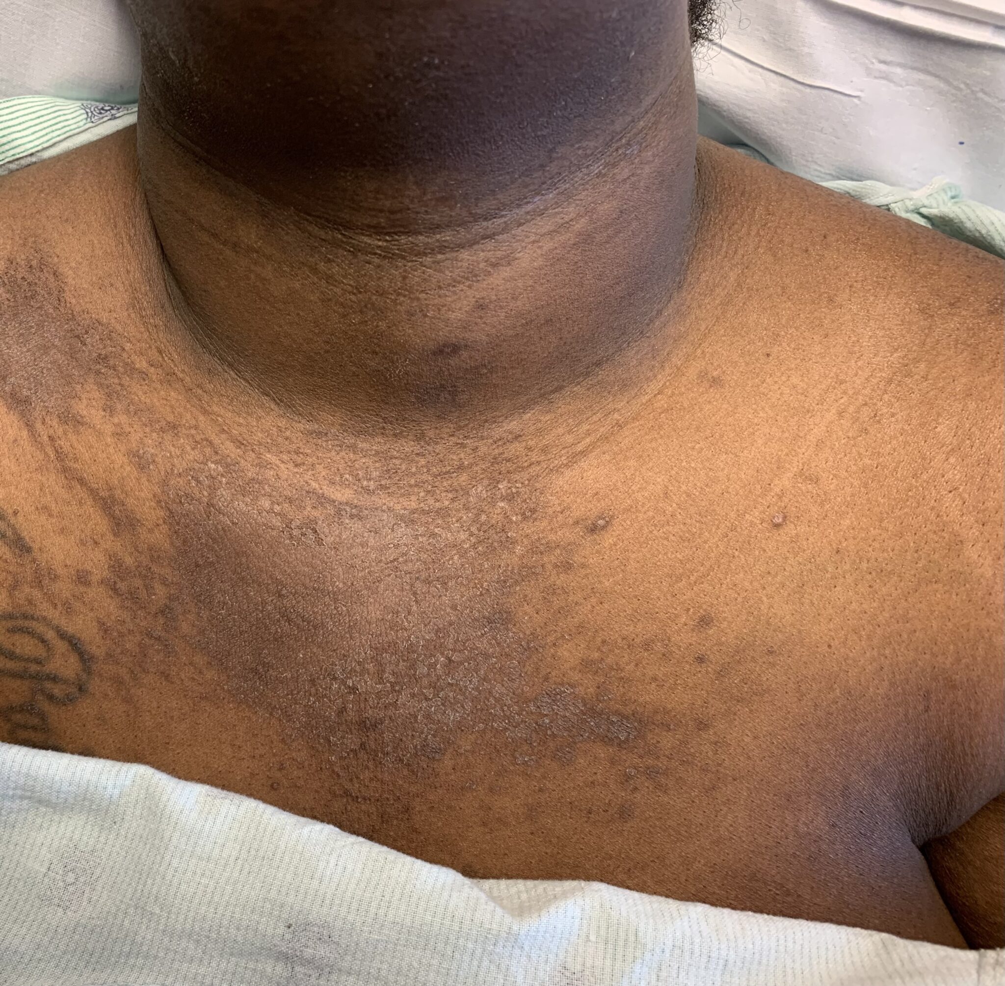 Case Report: Persistent Pruritic Plaques in Adult-Onset Still's Disease ...