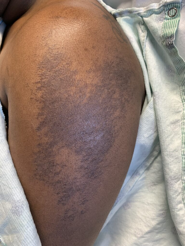 Case Report: Persistent Pruritic Plaques in Adult-Onset Still's Disease ...