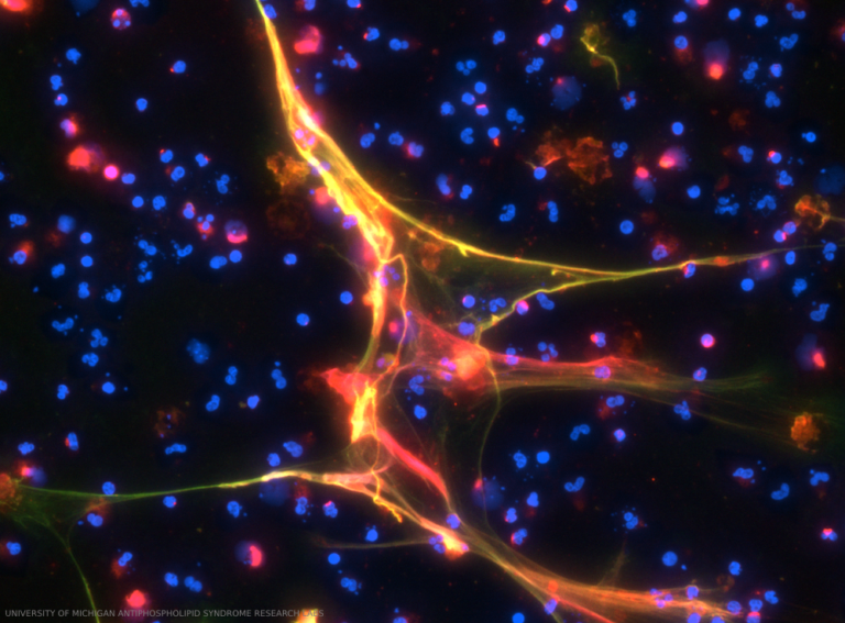 What Rheumatologists Need to Know About Antiphospholipid Syndrome - The ...