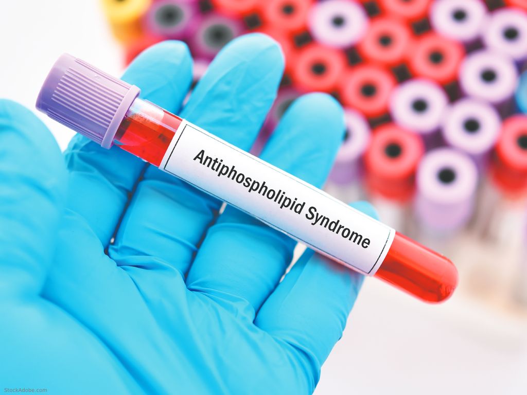 What Rheumatologists Need to Know About Antiphospholipid Syndrome - The ...