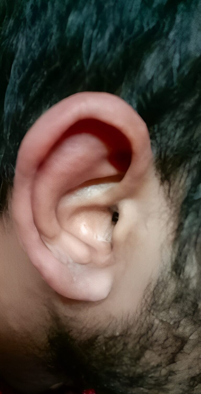 Case Report: Leprosy Masquerading as Relapsing Polychondritis - The ...