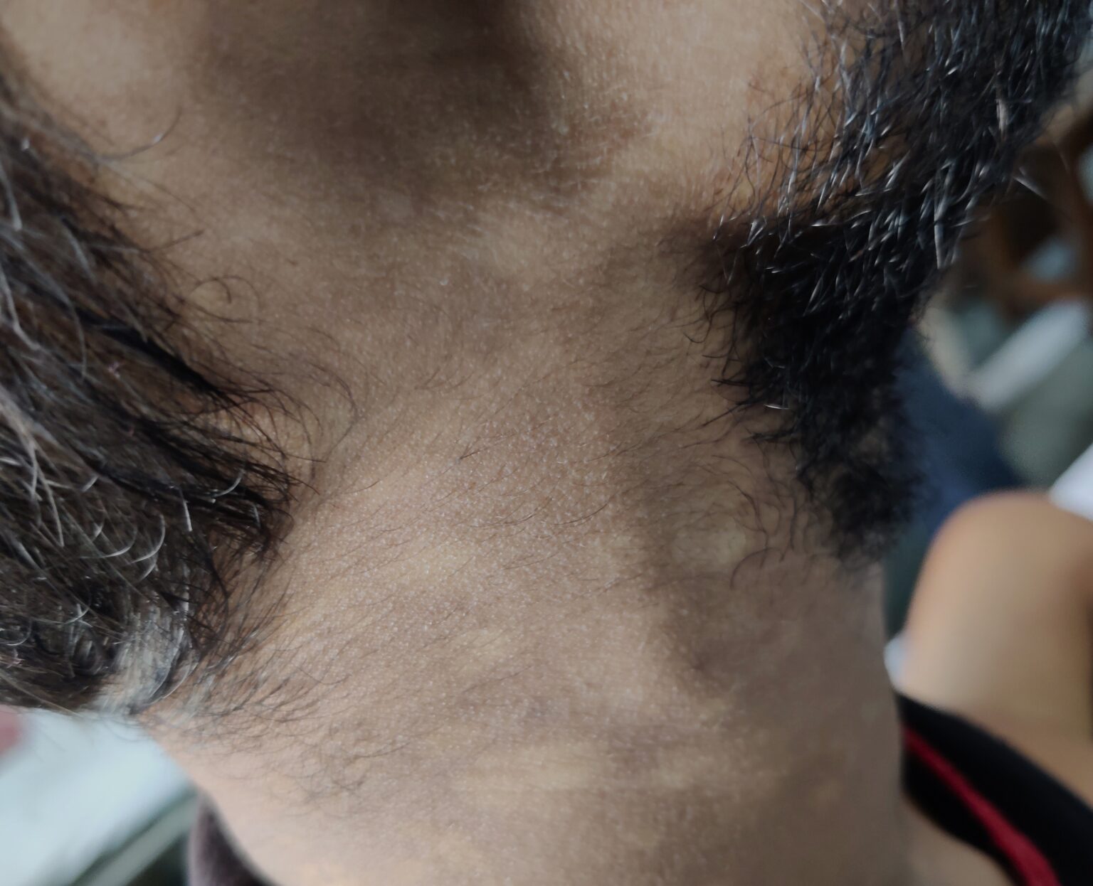 Case Report: Leprosy Masquerading as Relapsing Polychondritis - The ...