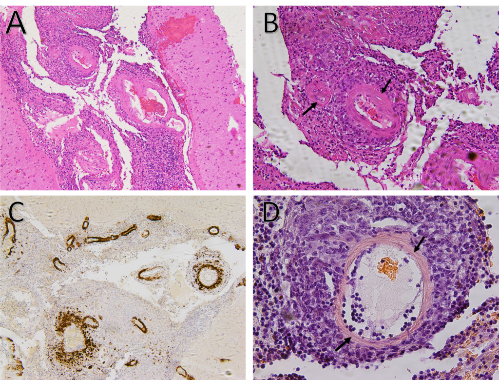 Case Report: Amyloid Beta-Related Angiitis of the Central Nervous ...