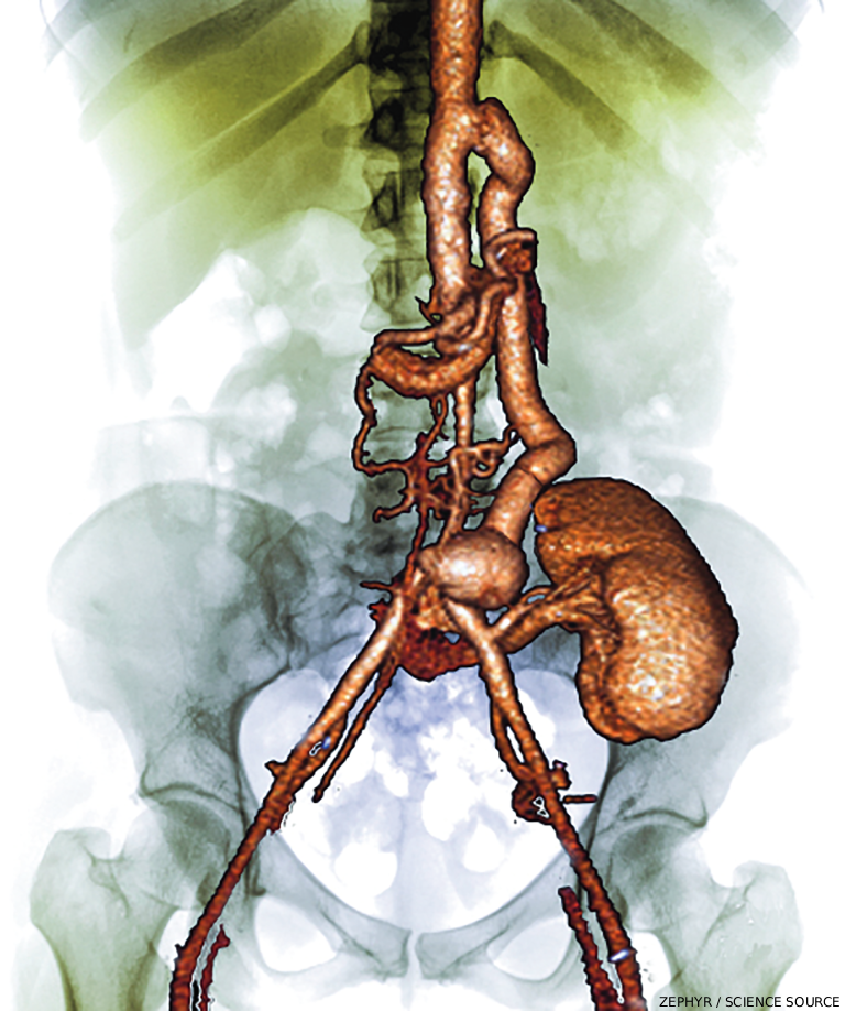 Study Finds Baricitinib Is Effective in Patients With Takayasu ...